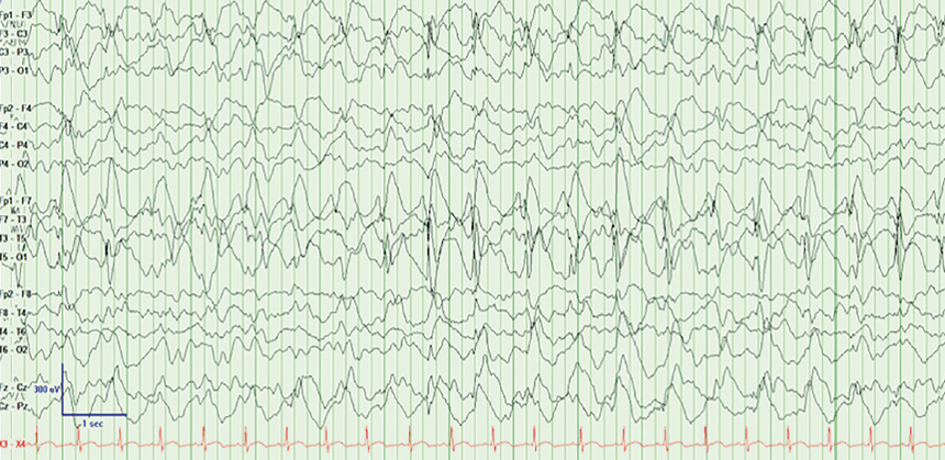 Progressive Drug-Resistant Epilepsy & Behavior Changes