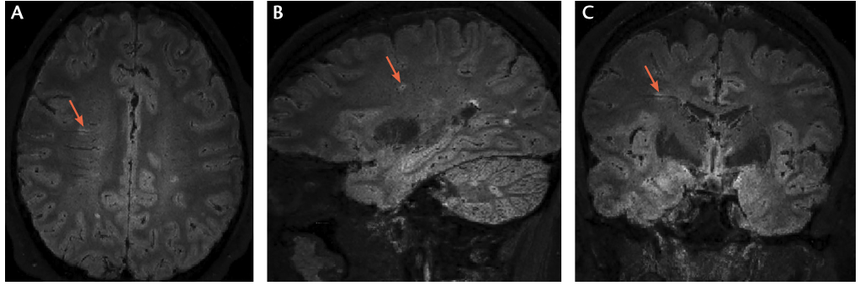 Multiple Sclerosis Minute: The Central Vein Sign in Diagnosi