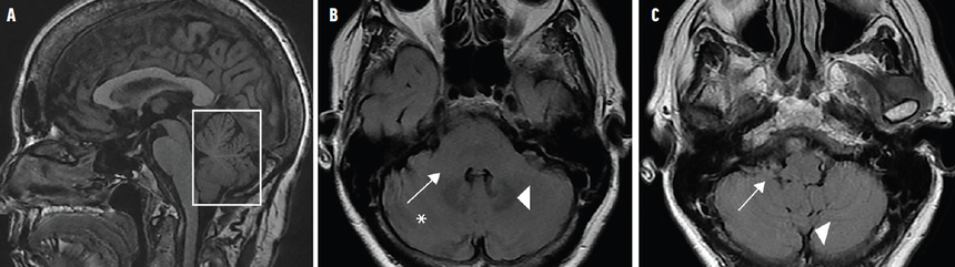 Adult-Onset Cerebellar Ataxias