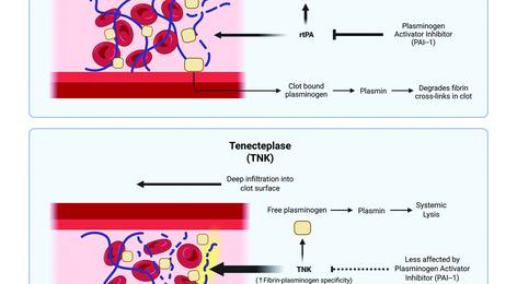 Stroke Spotlight: Hypercoagulable States in Ischemic Stroke