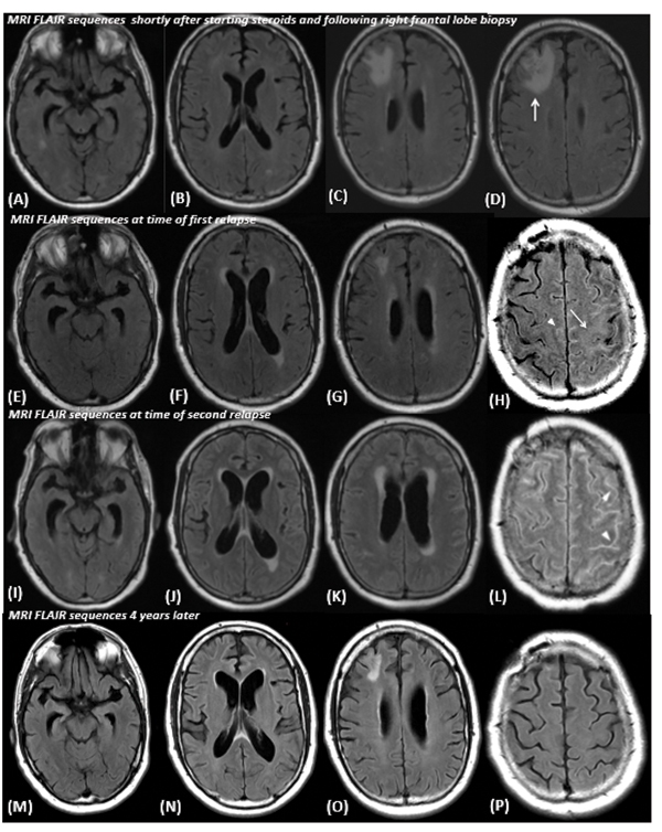 Treatment-Resistant Small Vessel Primary Angiitis of the CNS
