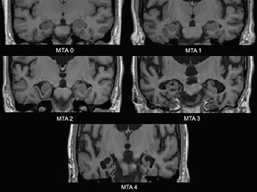 Brain Imaging in Differential Diagnosis of Dementia