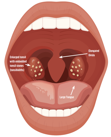 Tonsillectomy for the Treatment of Suspected Sleep Apnea wit