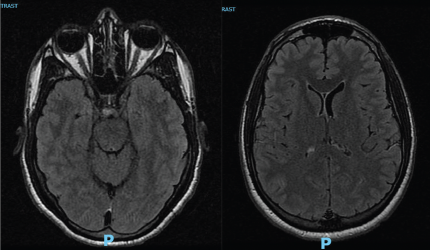 Reversible Cortical Blindness Secondary to Acute Carbon Mono