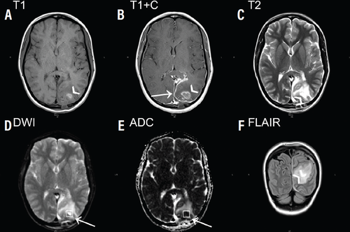 Intracranial Infections: Bacterial, Viral, Fungal, Parasitic