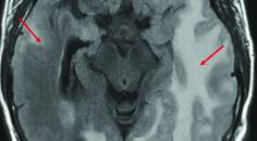 Meningeal Enhancement Seen on Workup for Memory Loss