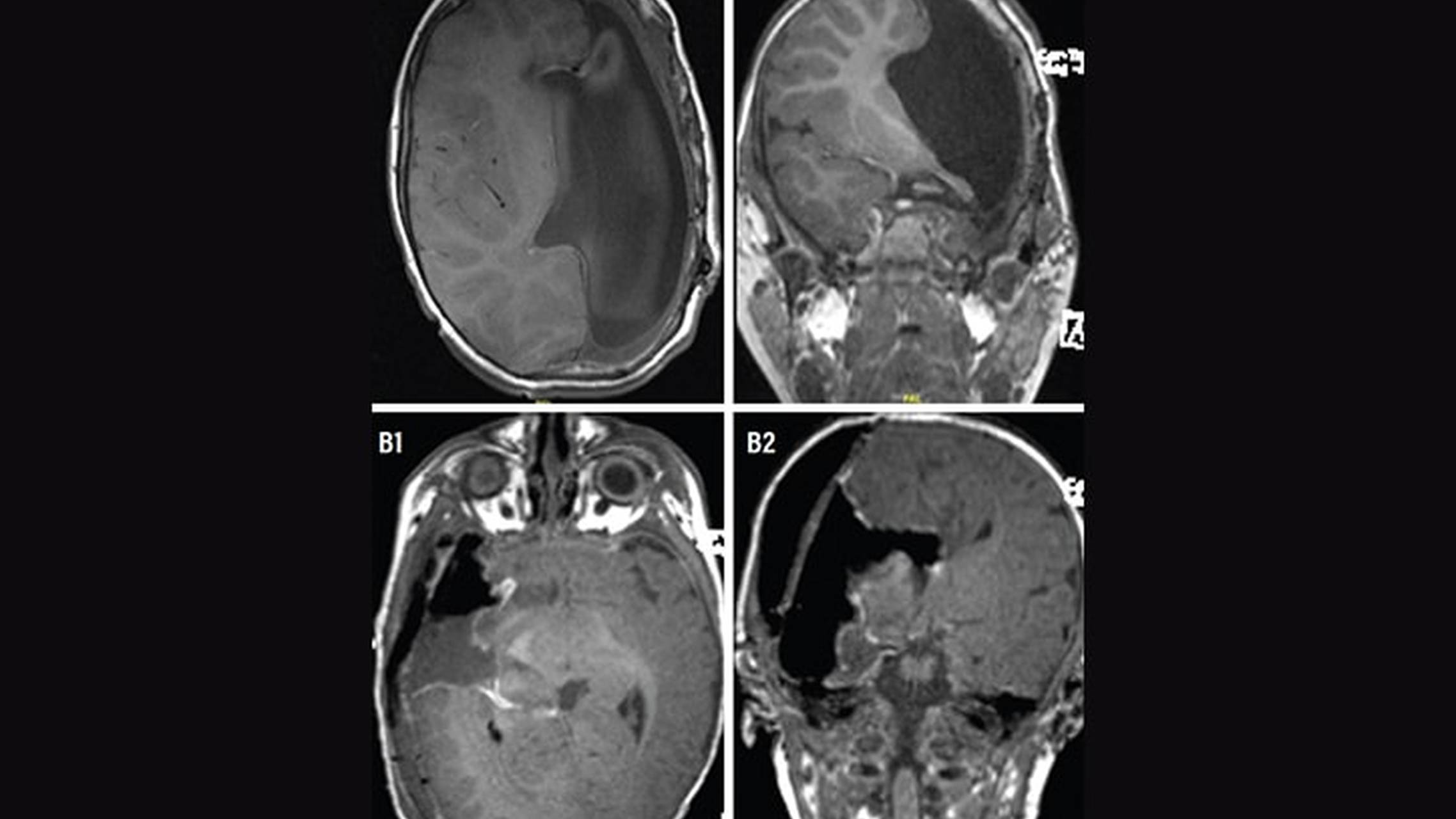 Epilepsy Essentials: Hemispherectomy for Early-Onset Pediatr