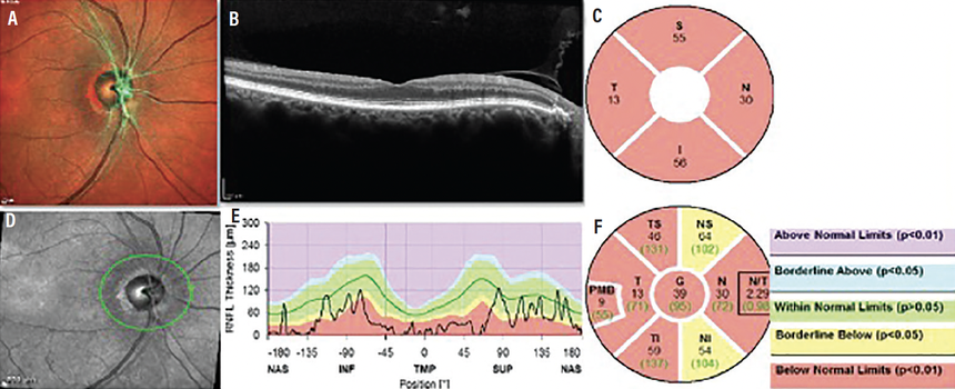 Optical Coherence Tomography & Neurology