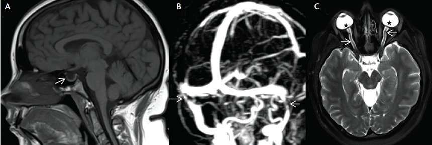 Ruling Out Secondary Headache