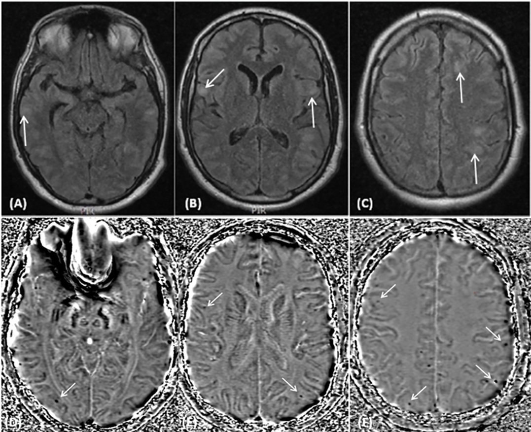 Treatment-Resistant Small Vessel Primary Angiitis of the CNS
