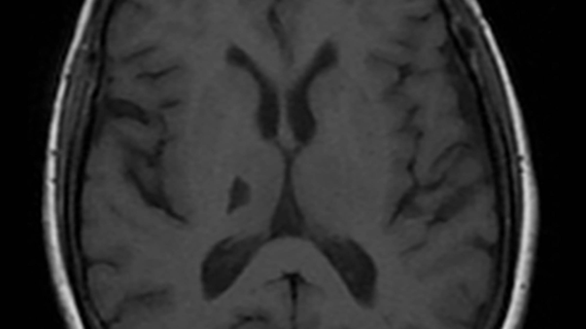 Understanding Dystonia: Diagnosis and Management