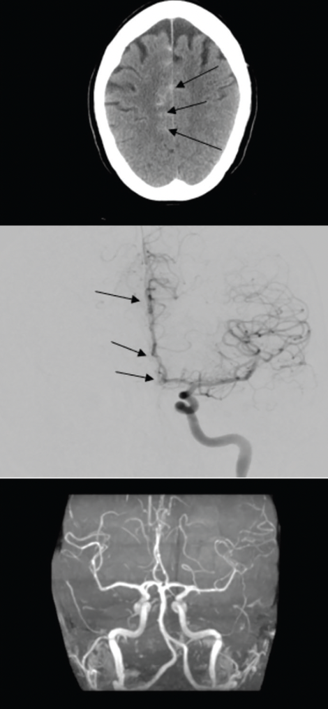 Headache Horizons: Reversible Cerebral Vasoconstriction Synd
