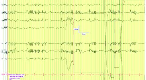 The New CPT Codes for Video-EEG