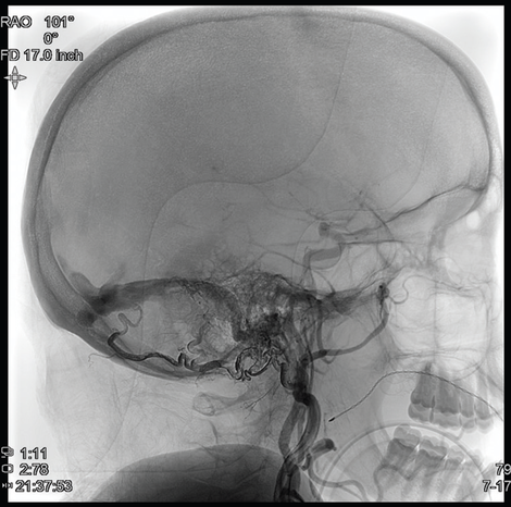 Pseudotumor Cerebri Syndrome Related to a Dural Arteriovenou