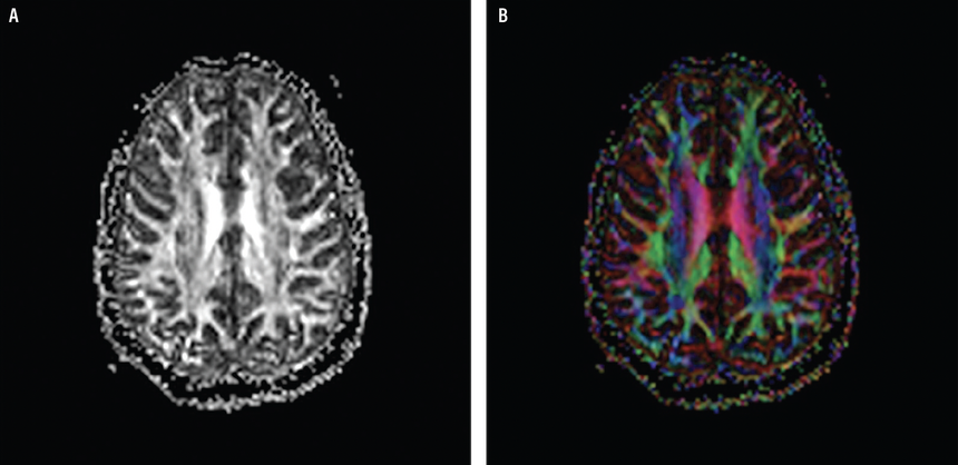 TBI Today: Quantitative Diffusion Tensor Imaging for Assessm