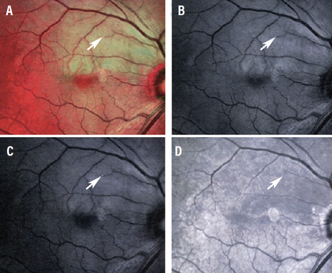 Optical Coherence Tomography & Neurology
