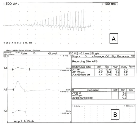 Diagnosis and Treatment of Lambert-Eaton Myasthenic Syndrome