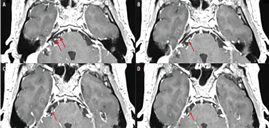 Arteriovenous Malformations & Trigeminal Neuralgia