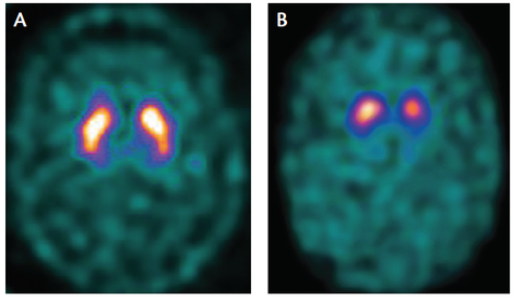 Imaging in Parkinson’s Disease
