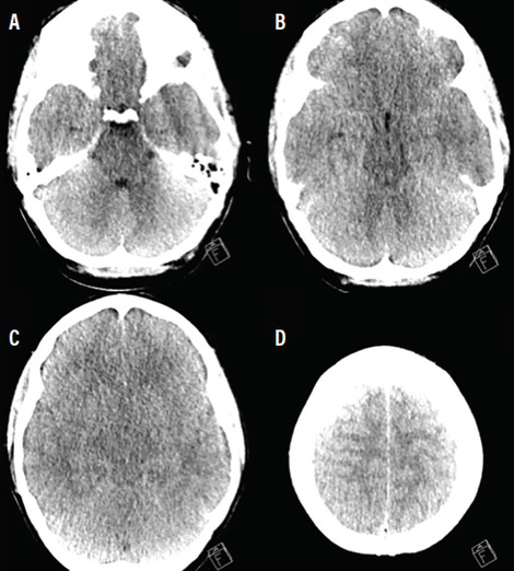 Case Report: Noninvasive Intracranial Pressure Monitoring