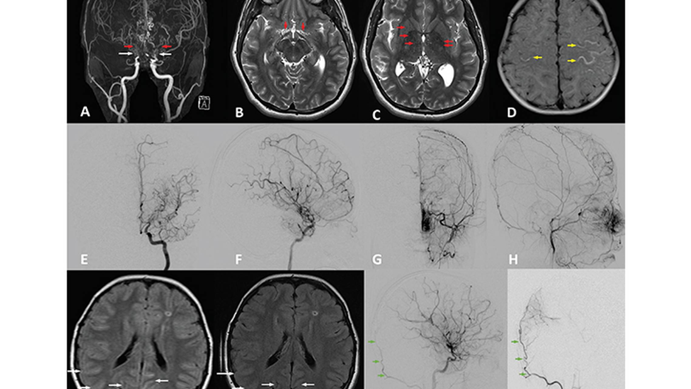 Moyamoya Disease