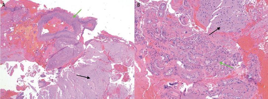 Spontaneous Intracranial Hemorrhage Secondary to Rare Pial A