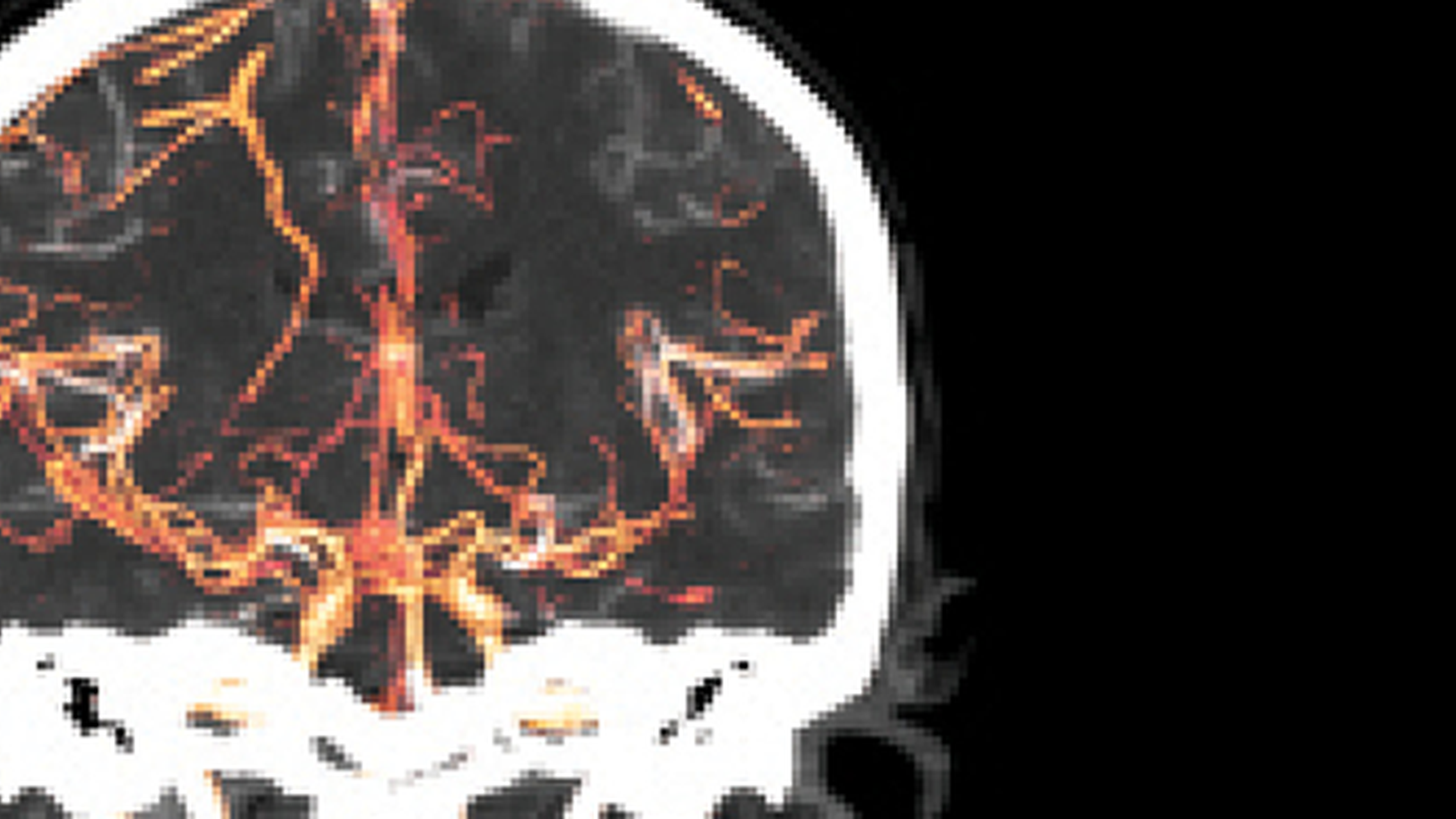 Subarachnoid Hemorrhage, Vasospasm, and Delayed Cerebral Isc