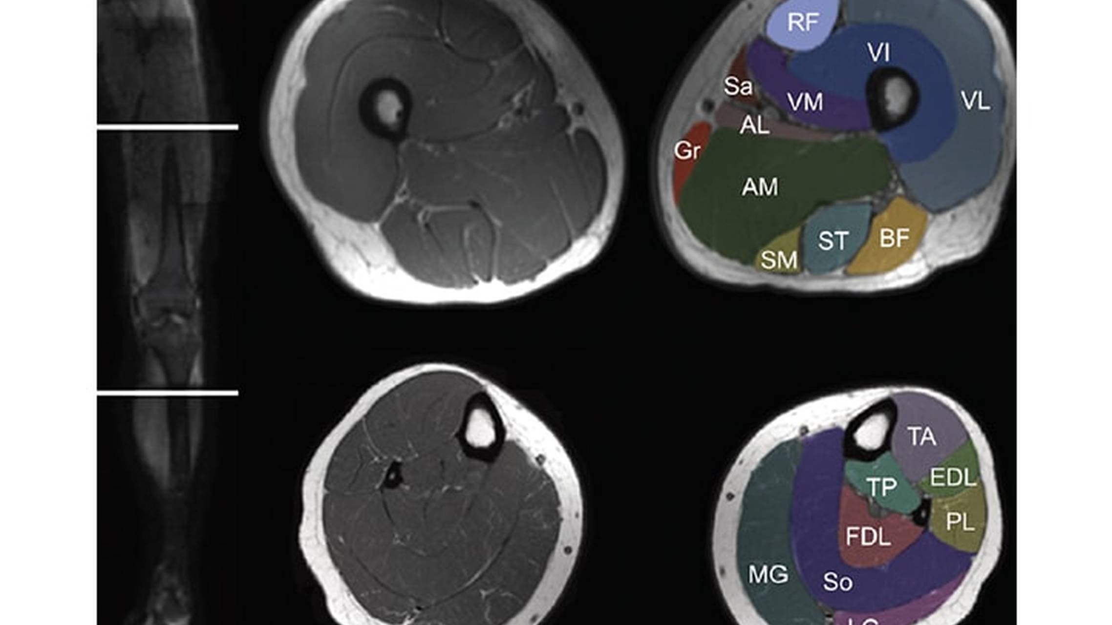 Muscle MRI for Neuromuscular Disorders