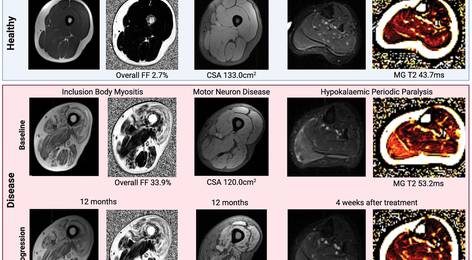 Differential Diagnosis of Distal Myopathies