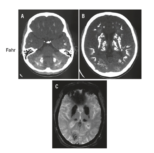 Understanding Dystonia: Diagnosis and Management
