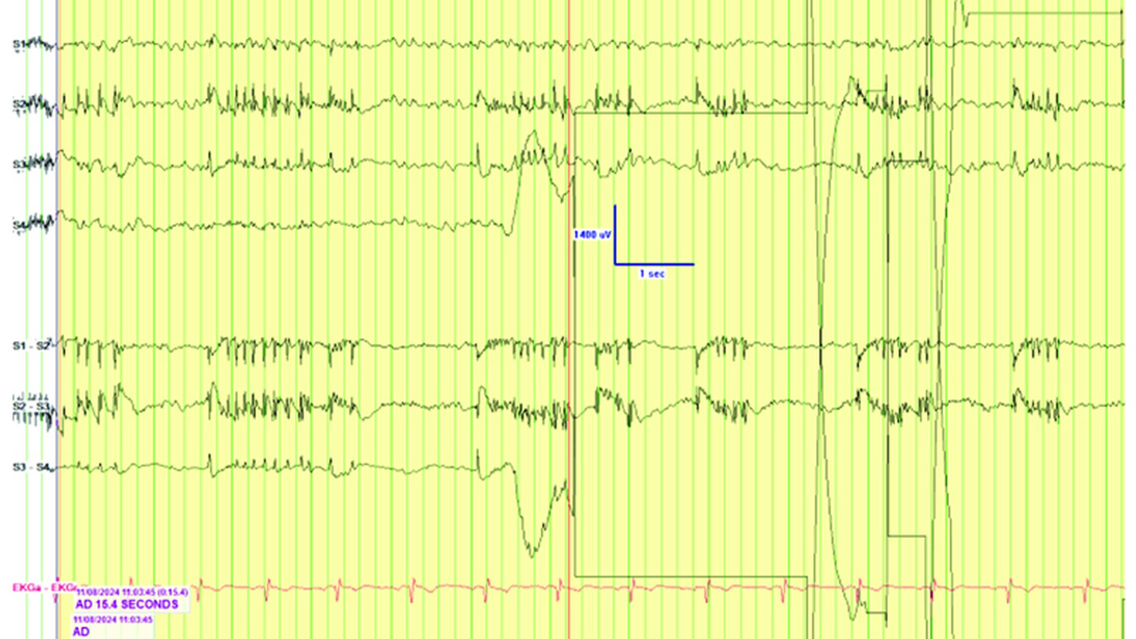 Practical Uses of EEG in the Operating Room