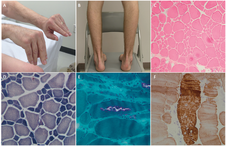 Differential Diagnosis of Distal Myopathies