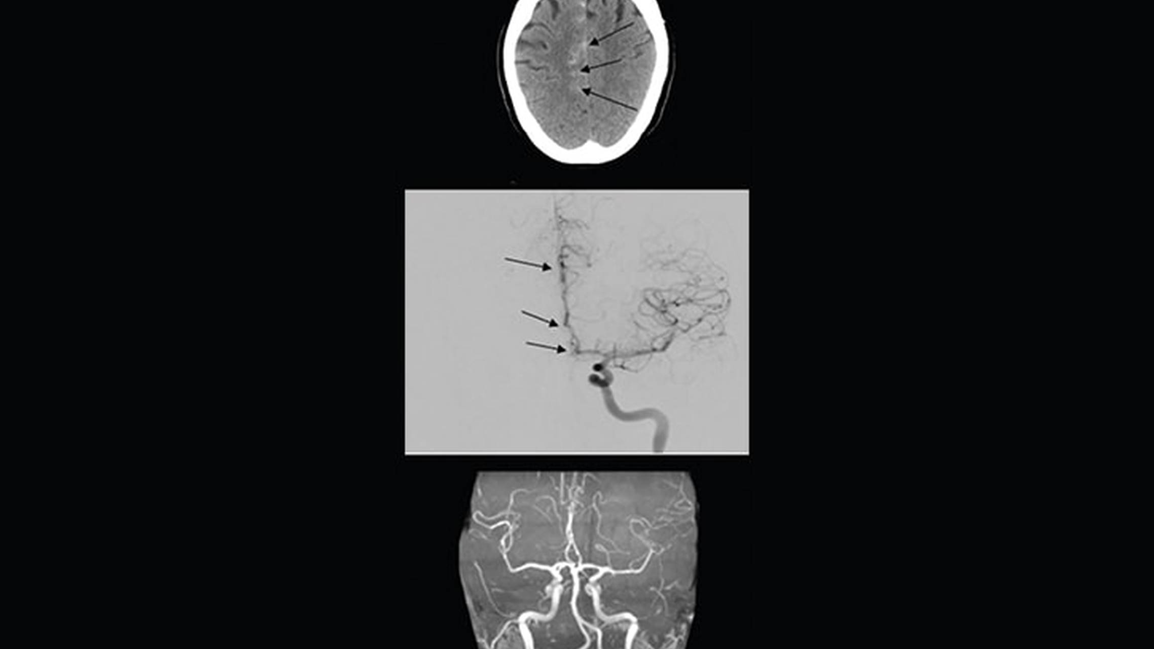 Headache Horizons: Reversible Cerebral Vasoconstriction Synd