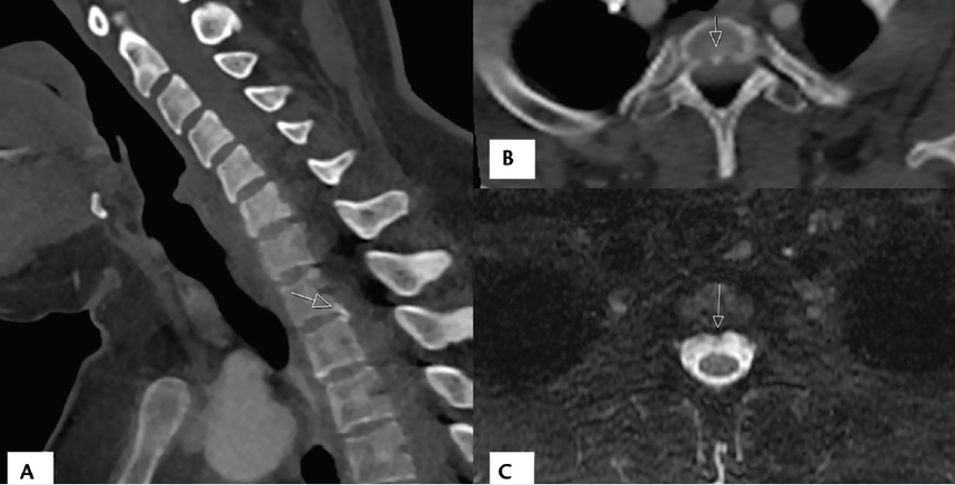 Headache Attributed to Spontaneous Intracranial Hypotension