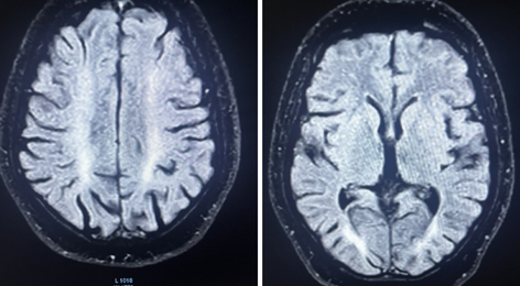 Diagnosis and Management of Muscle Cramps