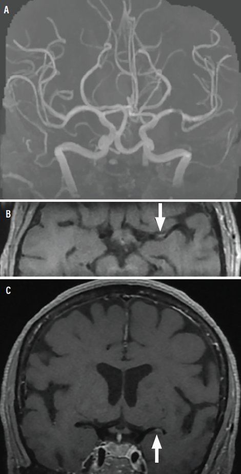 Stroke Snapshot: Intracranial MRI Vessel-Wall Imaging