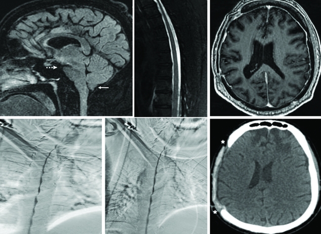 Pitfalls in Management of Intracranial Hypotension
