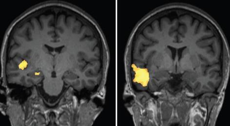 Epilepsy & Seizures