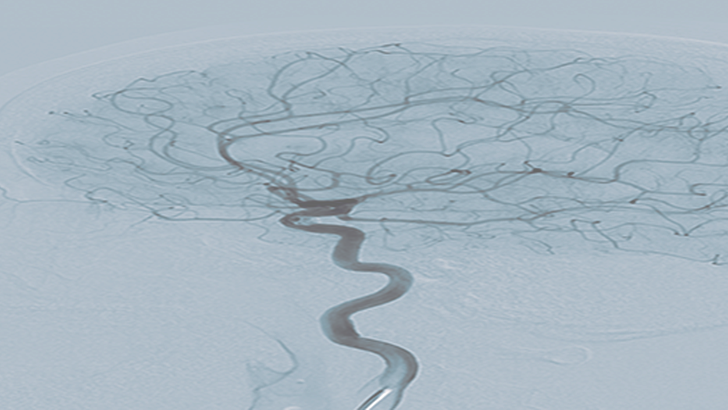 Spinal Cord Infarct: Clinical & Imaging Pearls