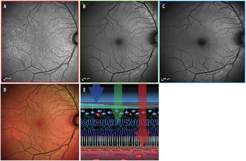 Optical Coherence Tomography & Neurology