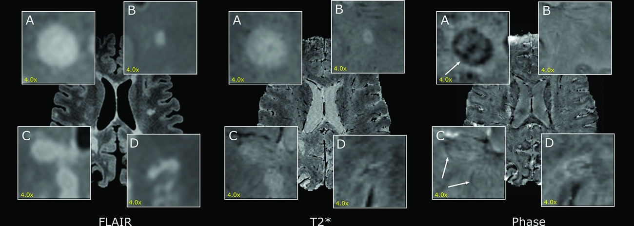 Radiologic Biomarkers in Multiple Sclerosis