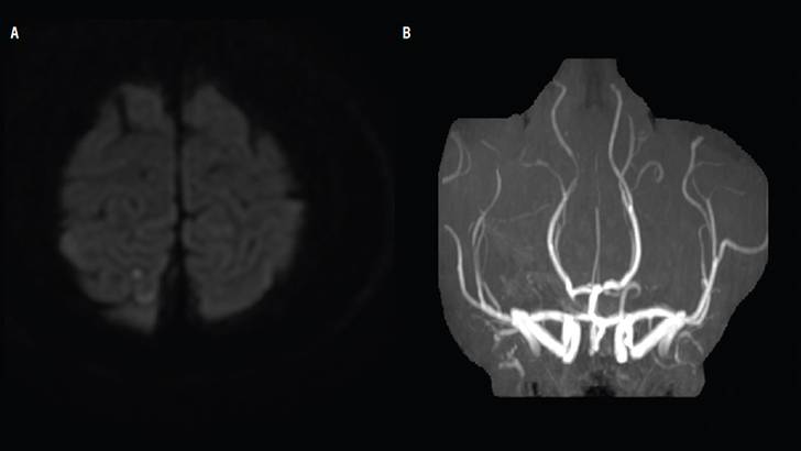 Case Report: Reversible Cerebral Vasoconstriction Syndrome P