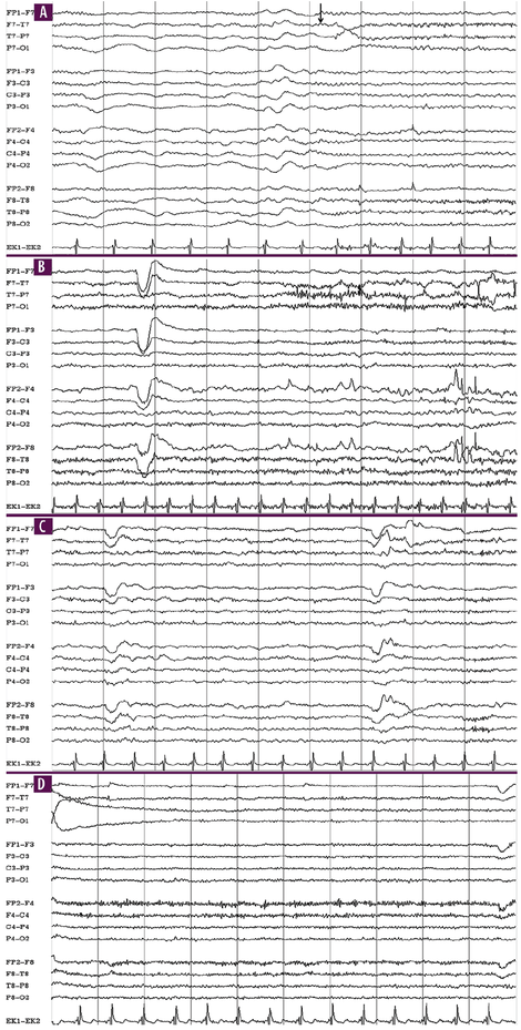 Epilepsy Essentials: VideoEEG Analysis