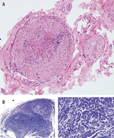 Neuromuscular Sarcoidosis: Peripheral Nervous System Manifes