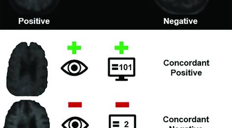 Meningeal Enhancement Seen on Workup for Memory Loss