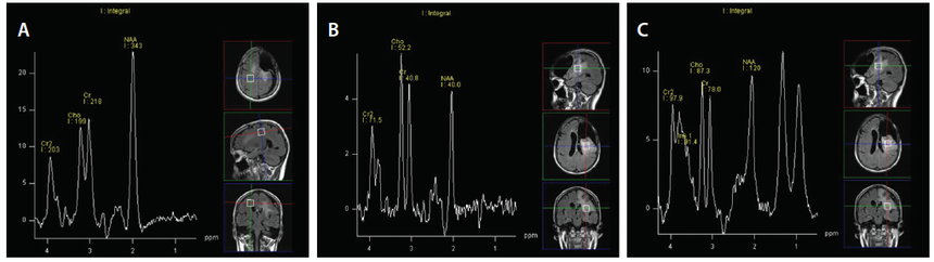 Special Report: Neuro-oncology