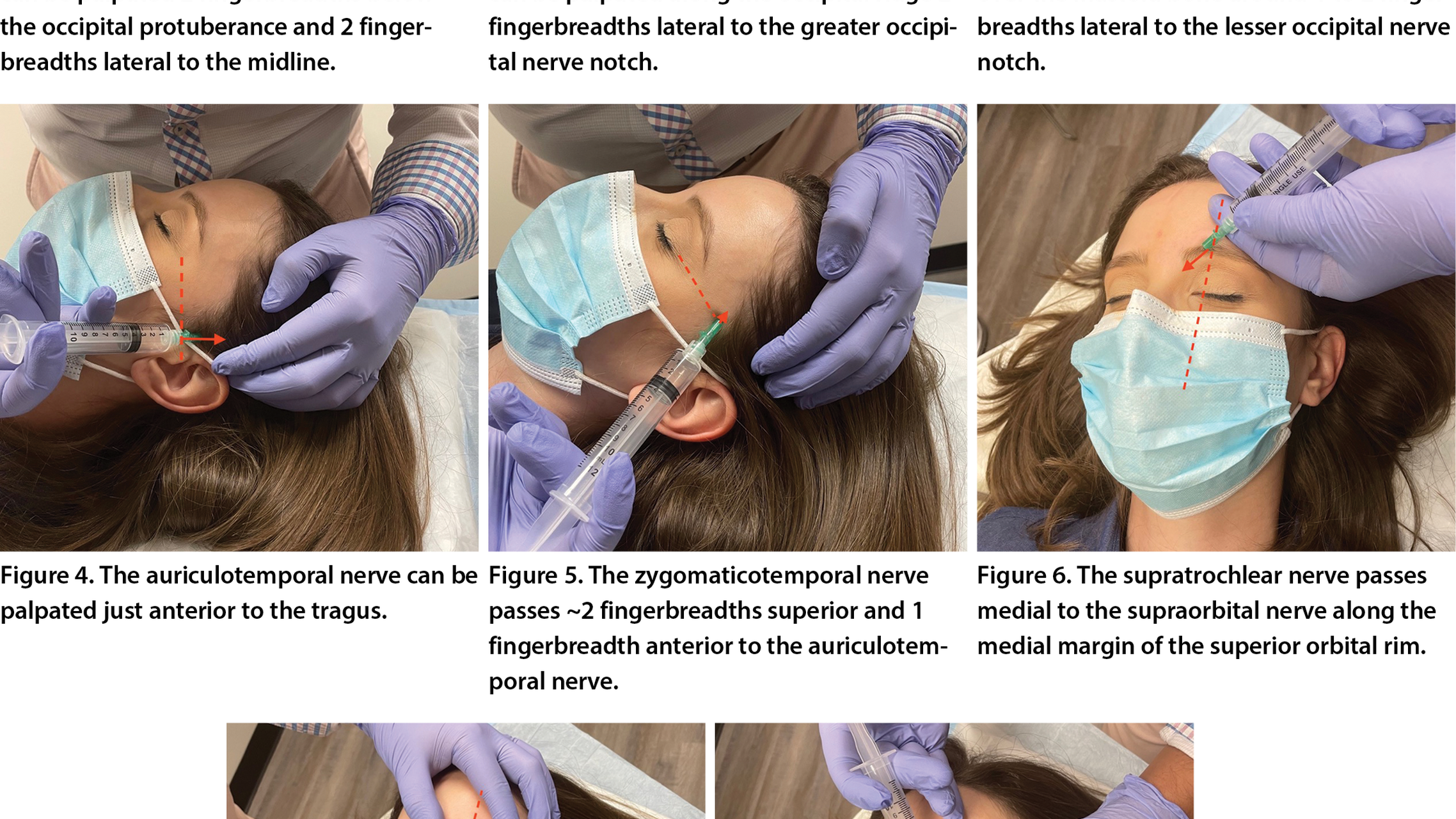 Non-Botulinum Toxin Injections for Headache—Current Evidence