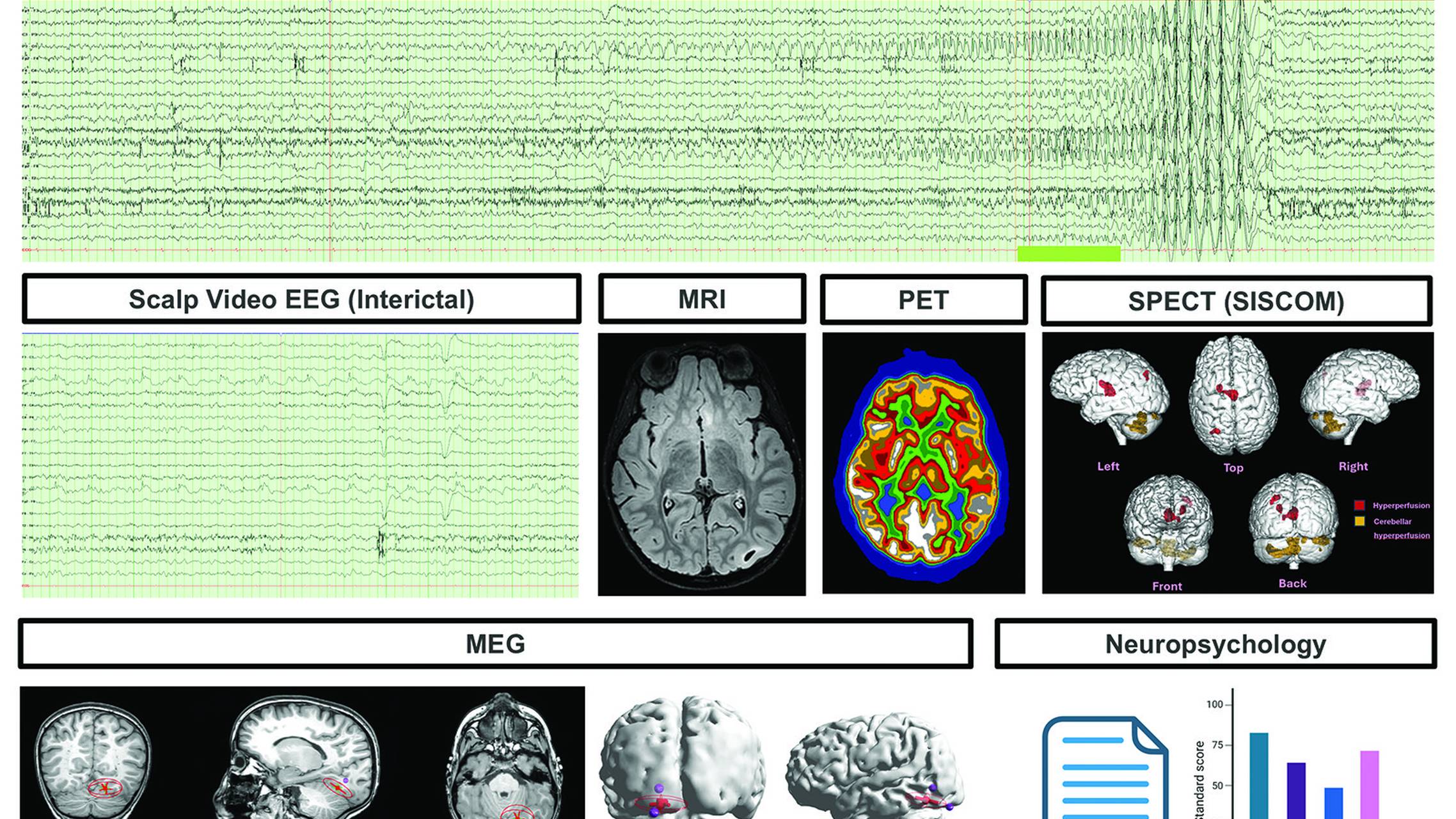 Utility of SEEG in the Treatment of Drug-Resistant Epilepsy
