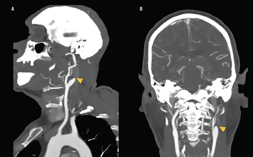 Corpus Callosum Stroke:A Rare Localization for an Isolated C