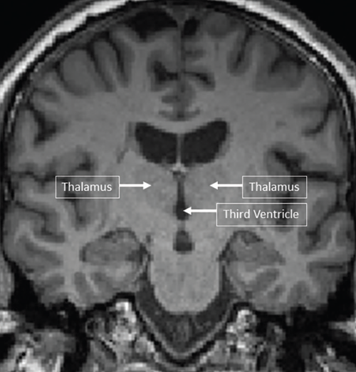 MS Minute: Cognitive Dysfunction in People Living with Multi